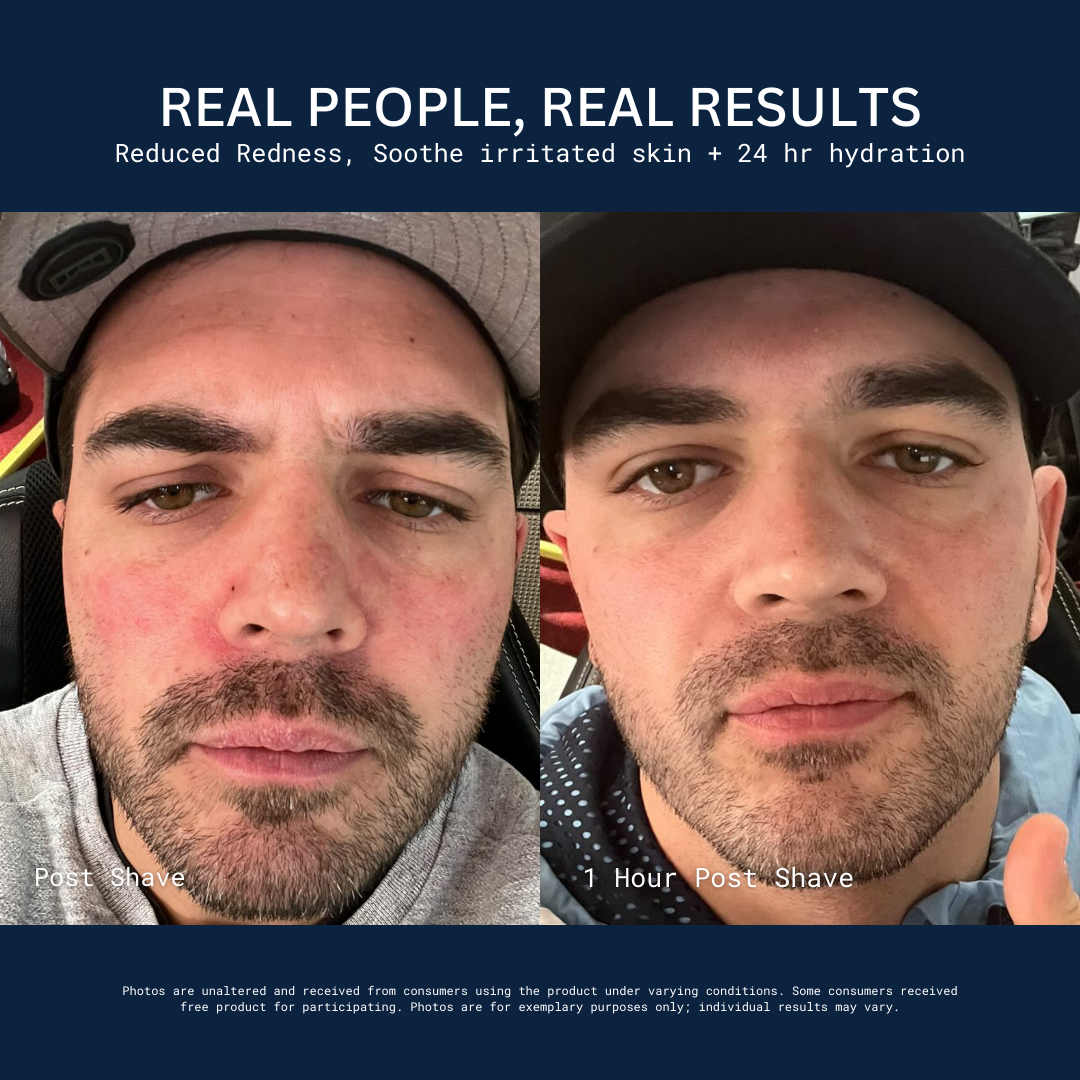 Male Eye Bags: 5 Common Causes & How to Get Rid of Them